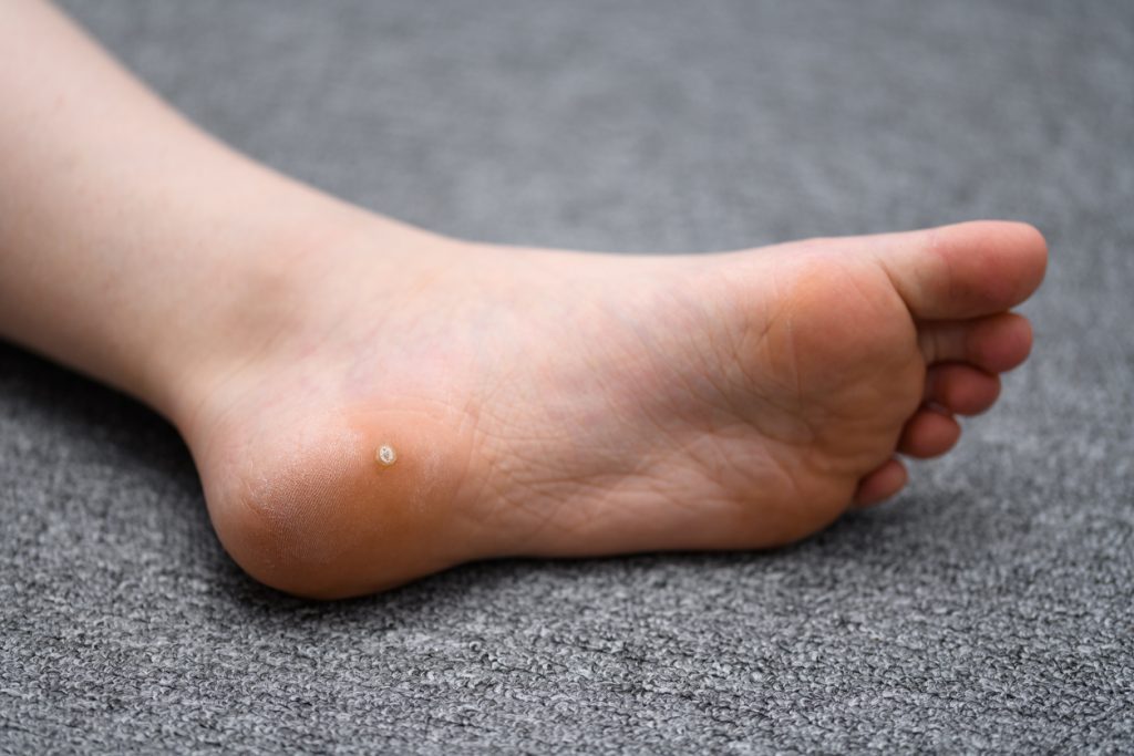 Verrucae (Plantar Warts) - myPod Podiatry